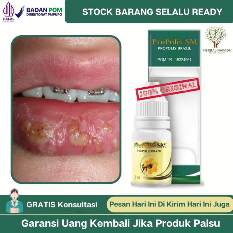 Jual Obat Herpes Mulut Menahun, Obat Luka Melepuh Sekitar Bibir, Obat ...