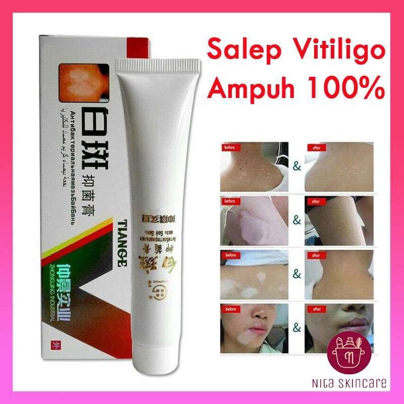 Promo Obat Salep Vitiligo Salep Tiange Penghilang Bercak Putih Bintik ...