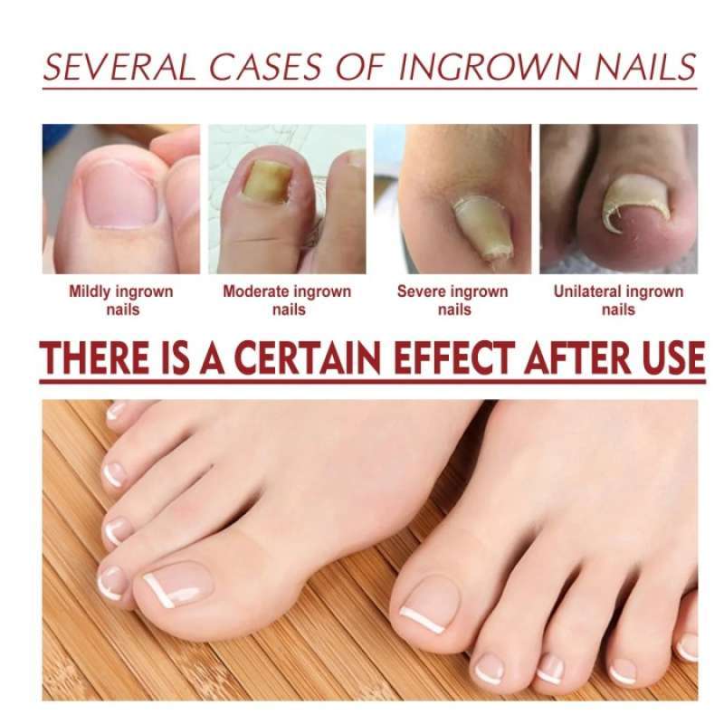 Jual Anti Paronychia Relief Oil Ingrown Toenail Drops Anti Fungal Toe ...