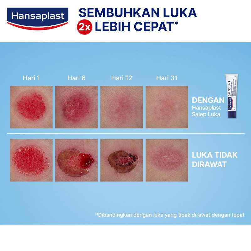 Promo Hansaplast Salep Luka [1 Pcs X 20 Gr] - Salep Perawatan Luka ...