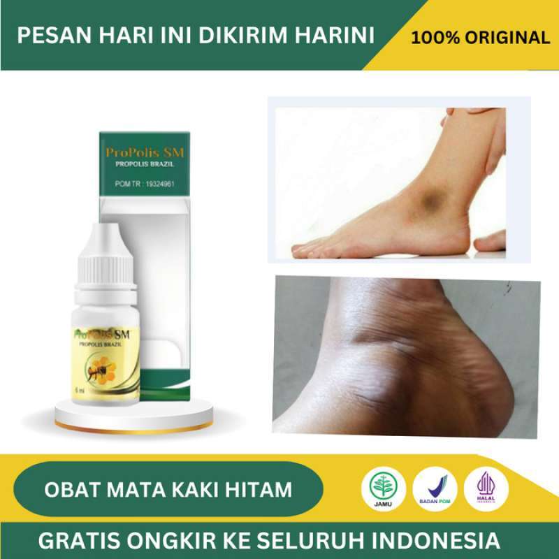Jual Obat Mata Kaki Hitam , Mata Kaki Kapalan ,pecah Pecah,mata Kaki ...