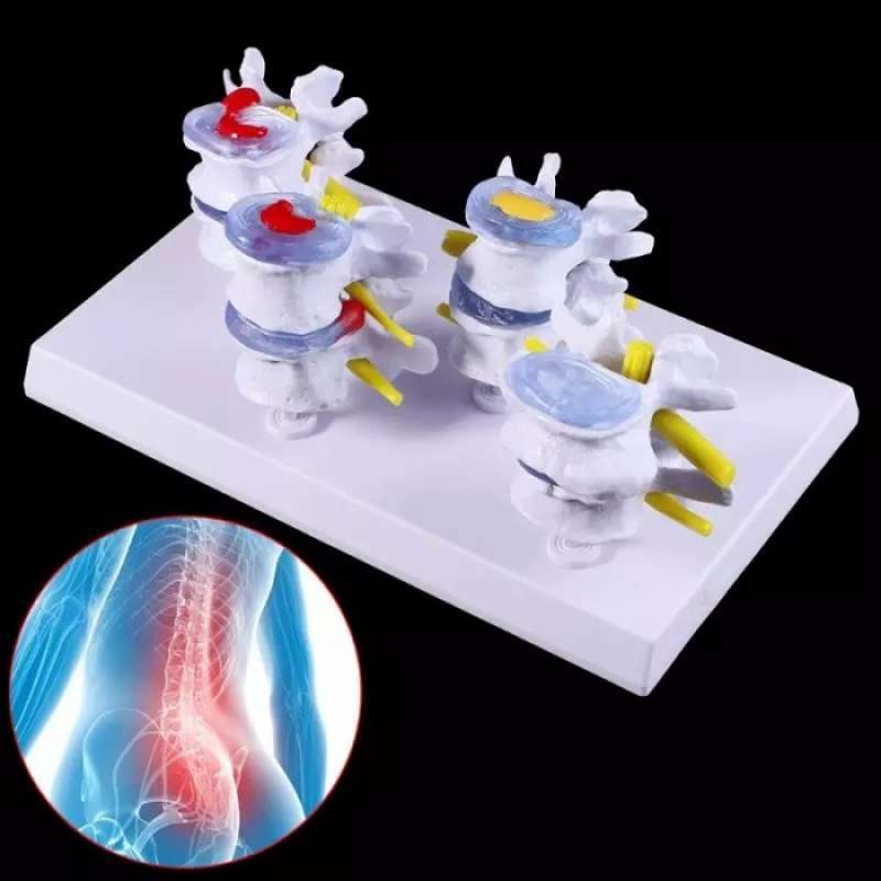 Jual Model Anatomi Medical Props Model 1 Set Human Lumbar Lesion Spine ...