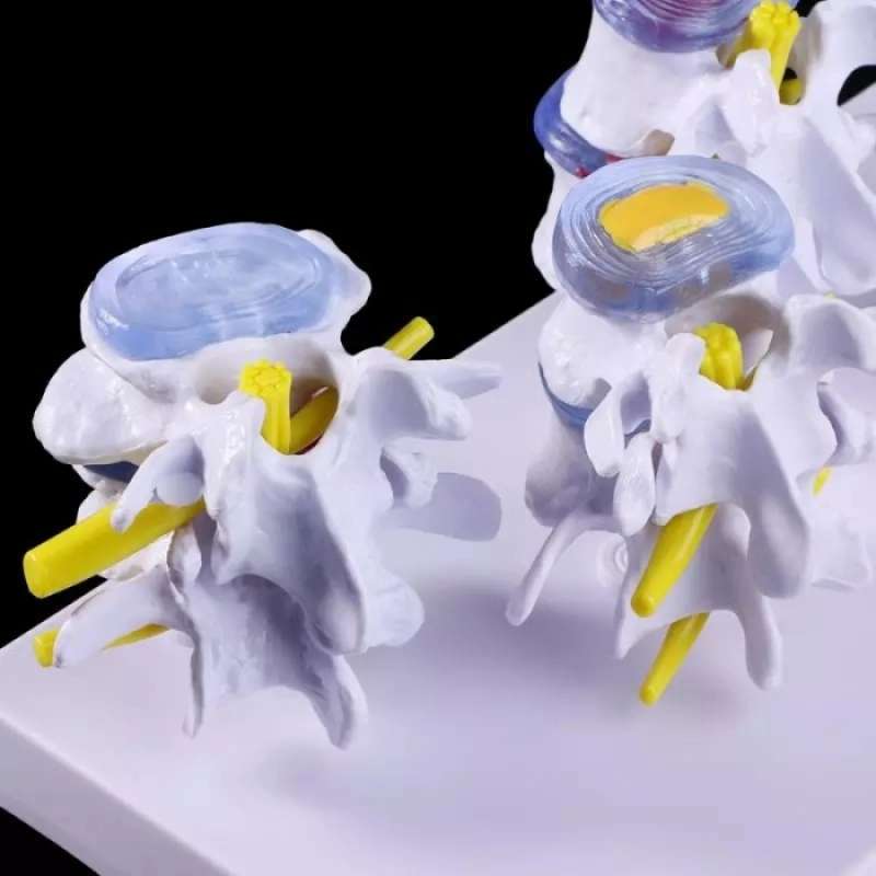 Jual Model Anatomi Medical Props Model 1 Set Human Lumbar Lesion Spine ...