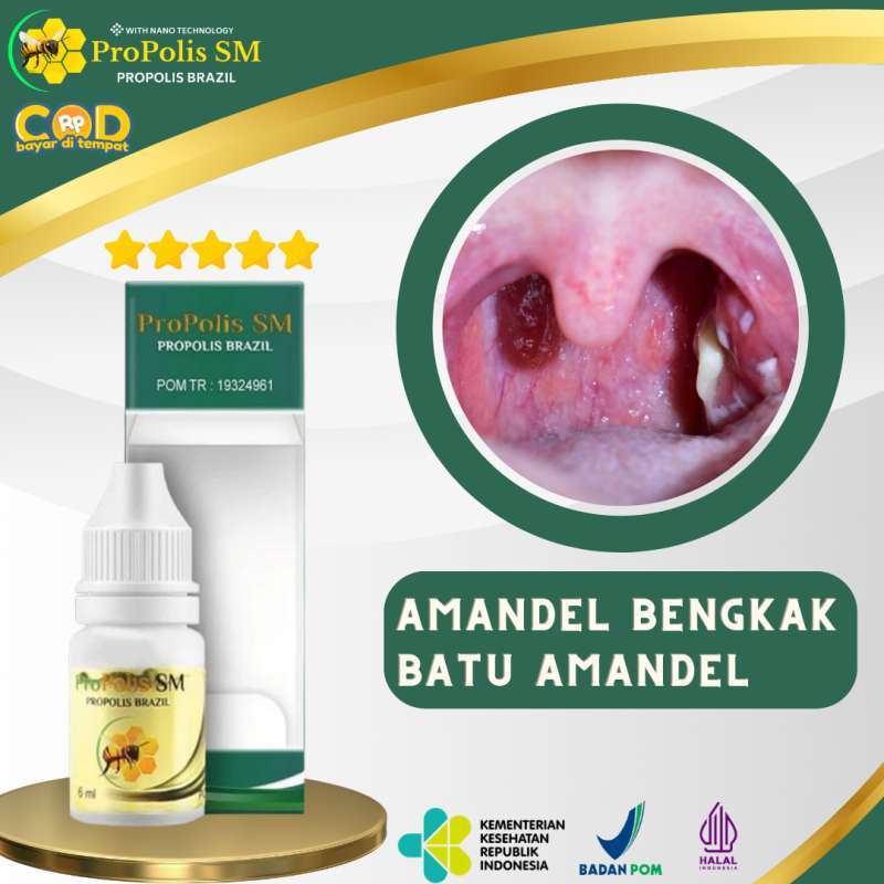 Jual Obat Amandel Untuk Anak Dan Dewasa Radang Amandel Tongsil Infeksi ...