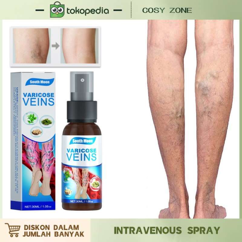 Jual South Moon Varicose Veins Spray Effective Varicose Vein Relief ...