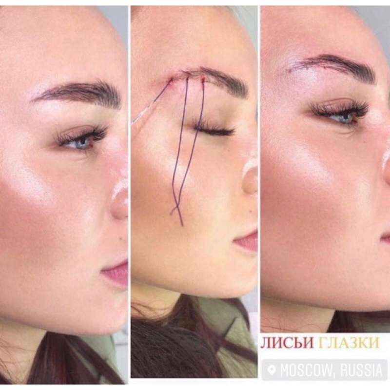 Promo Korea Meline Benang Alis Fox Eye PDO V-Lifting 21G-60mm isi 5 pcs Diskon 23% di Seller ...