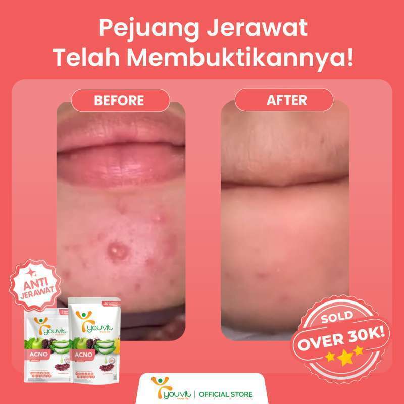Promo Youvit AcNO 3 sachet (21 Hari) dengan Vitamin A, Niacinamide, Aloe Vera untuk Anti Jerawat ...