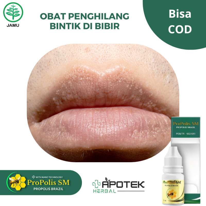 Jual Obat Penghilang Bintik di Bibir Fordyce Spots Alergi Herpes ...
