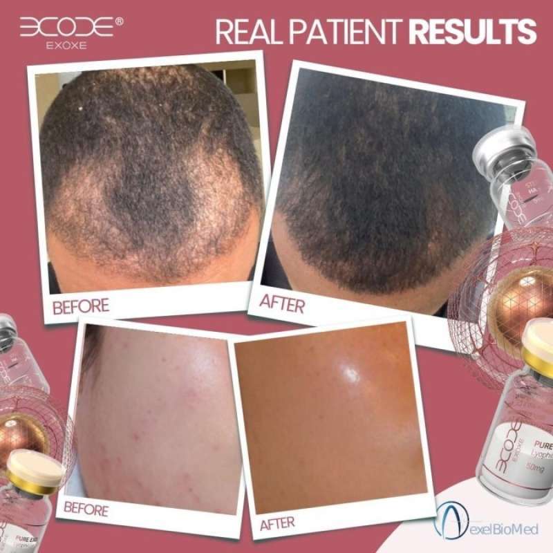 Jual Exoxe Exosome Purest No. 1 Collagen Stimulator + Skinbooster Di ...