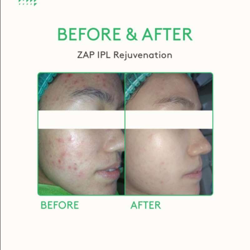 Promo 2x Ipl Rejuvenation + Free Oxy Infusion + Free Pharma Care Cream ...