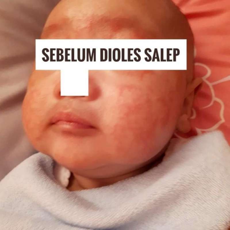 Jual Salep Eczema Atau Cream Atopic Dermatitis Salep Eksim Dan Alergi ...