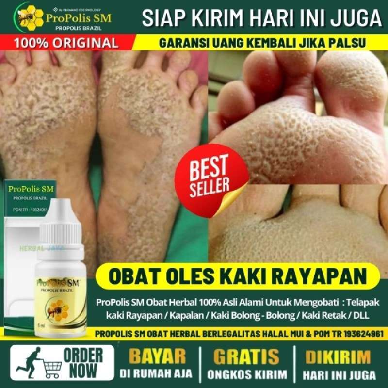 Jual Obat Tumit Pecah / Retak, Telapak Kaki Berlubang Lembab & Bau ...