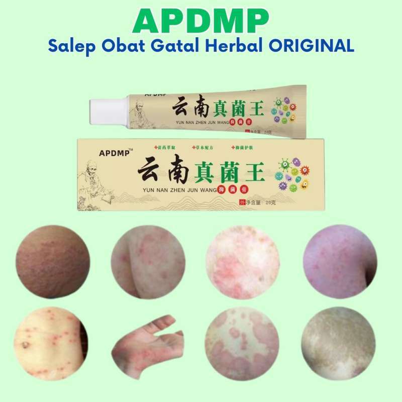 Jual Apdmp Salep Gatal Kulit Ampuh Salep Cina Gatel Exim Kulit Salep ...
