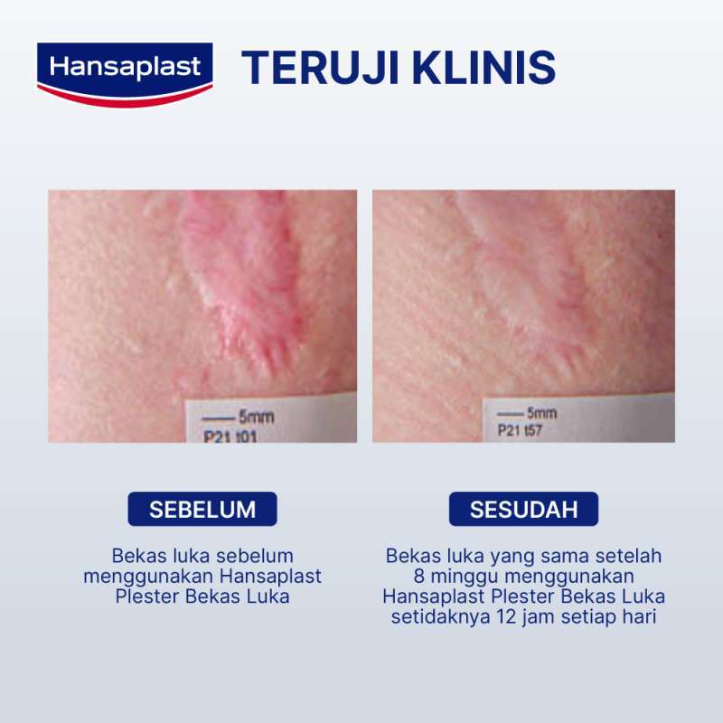 Jual Hansaplast Plester Bekas Luka [21 Lembar] - Menghilangkan Bekas ...