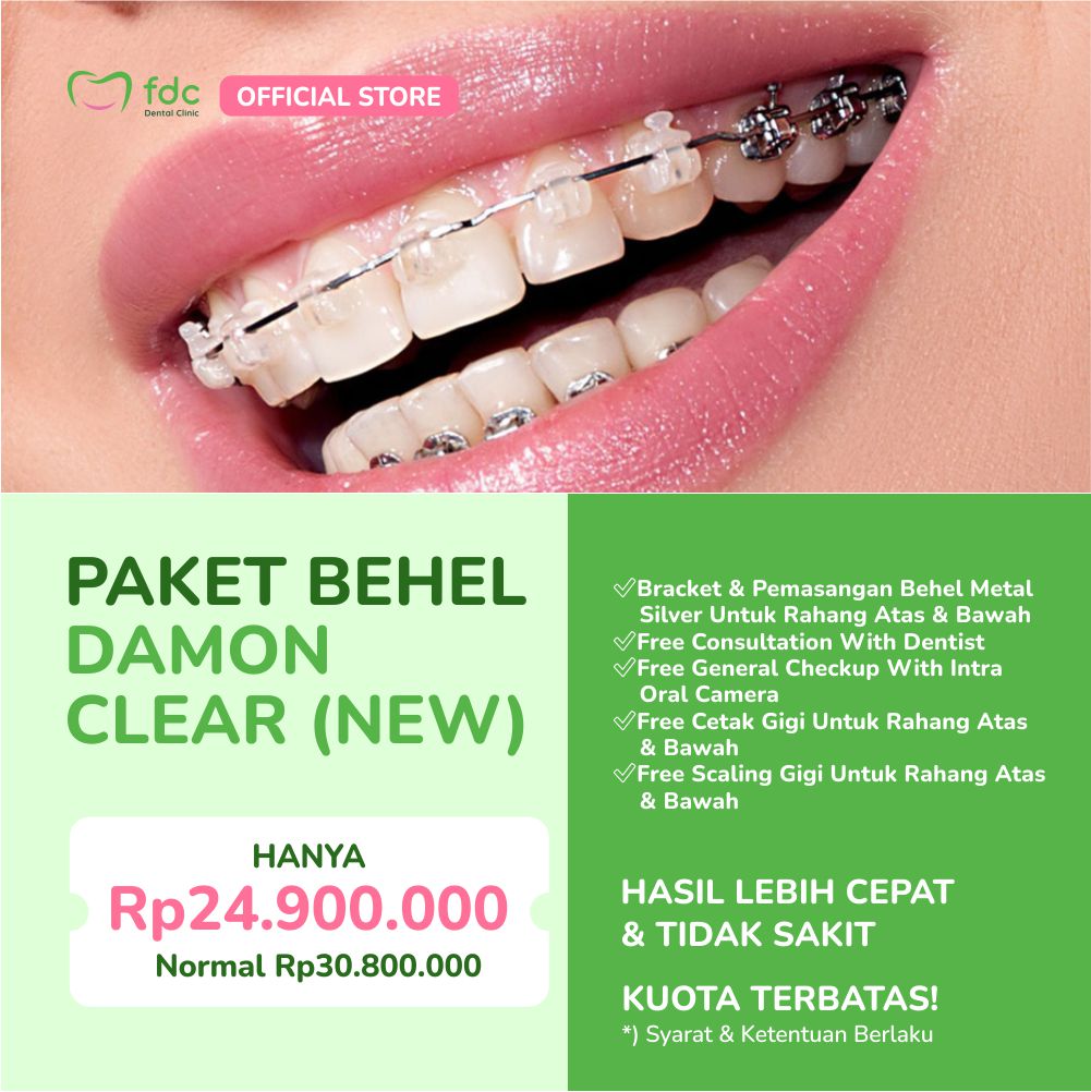 Promo FDC Dental Clinic- Behel Damon Clear Diskon 19% di Seller FDC Dental Clinic Official Store ...