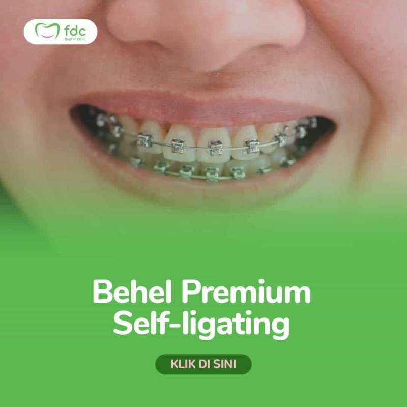 Jual Behel Self Ligating Terbaik - Harga Terbaru 2024 | Blibli