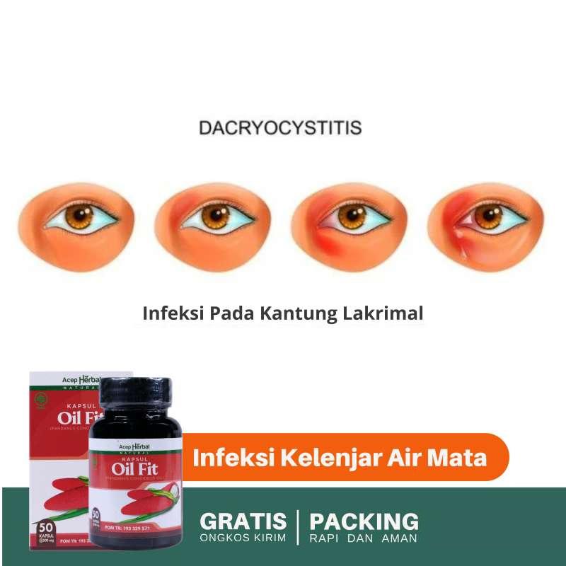 Jual Obat Dakriosistitis, Infeksi Kelenjar Air Mata, Kelenjar Lakrimal ...