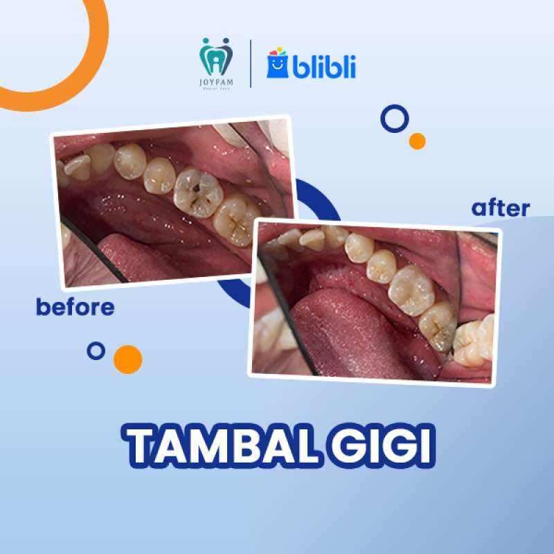Promo Joyfam Tambal Gigi Dewasa Diskon 40 Di Seller Joyfam Dental