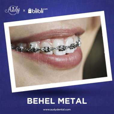 Jual Voucher Behel Self Ligating Empower - Clippy Metal Audy Dental ...