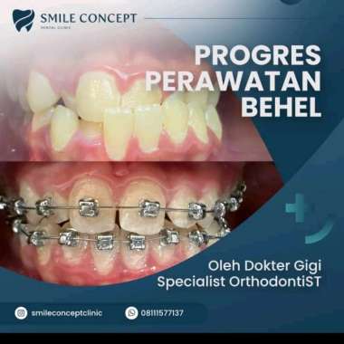 Damon Brace Lengkap Harga Terbaru Mei 2023 | Blibli